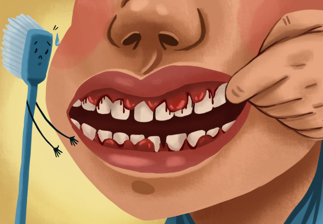 What Is Gingivitis? | Seaport Family Dentistry | Liberty, MO